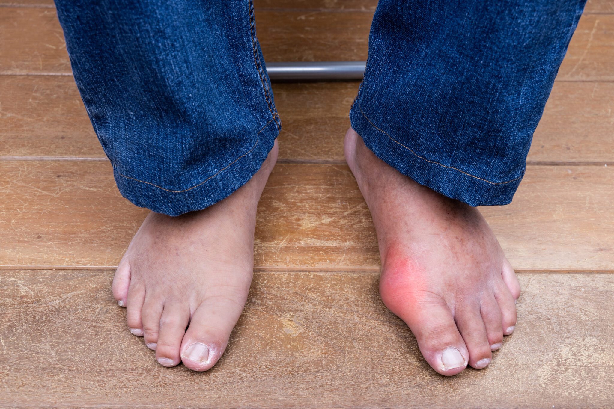 4 Early Signs of Bunions & How to Treat Them
