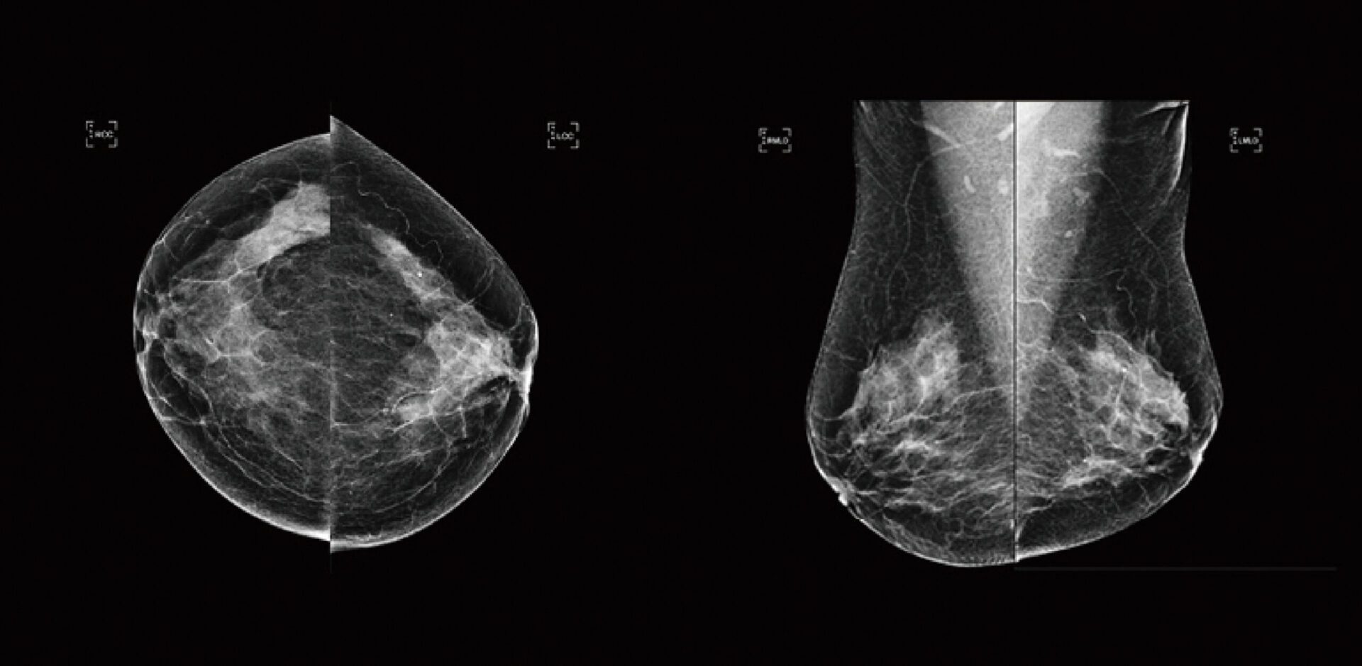 Mobile 3D Mammography in Arizona | HealthyU Clinics